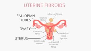 Acessa System’s Removal of Fibroids: A Huge Advancement for Walnut Hill ...