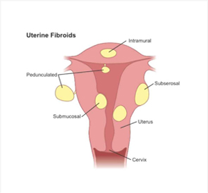 Acessa System’s Removal of Fibroids: A Huge Advancement for Walnut Hill ...